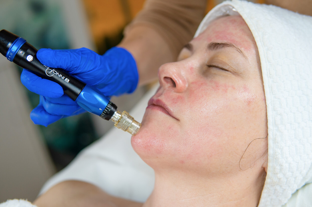 Innopen & CRL Medical Needling Tools