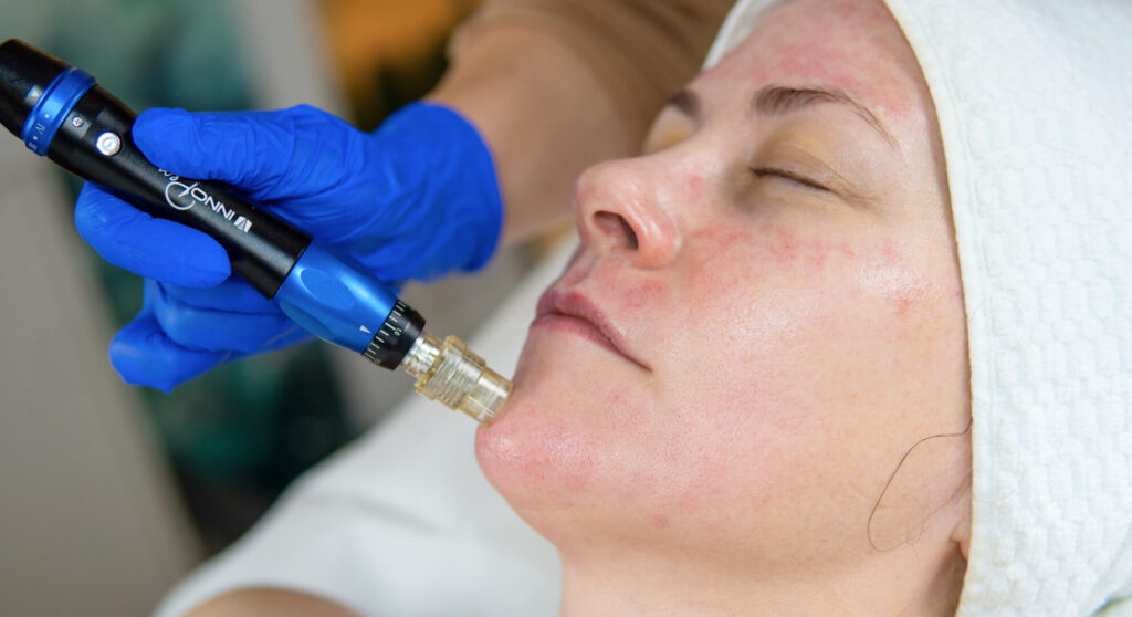 Innopen & CRL Medical Needling Tools