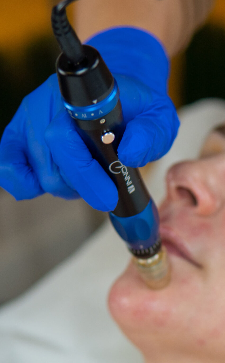 Innopen & CRL Medical Needling Tools